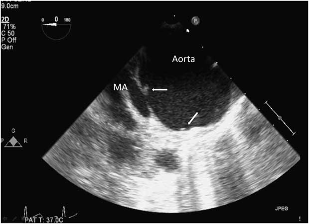 Infective endocarditis, thoracic aortitis, and mycotic aneurysm ...