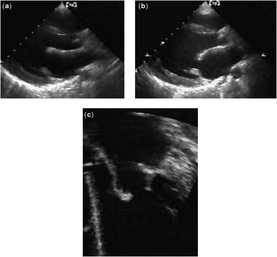 Libman–Sacks endocarditis as the first manifestation of systemic lupus ...