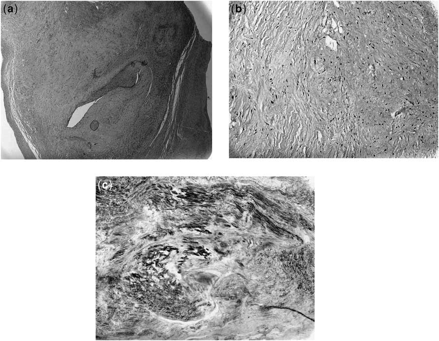 Libman–Sacks endocarditis as the first manifestation of systemic lupus ...