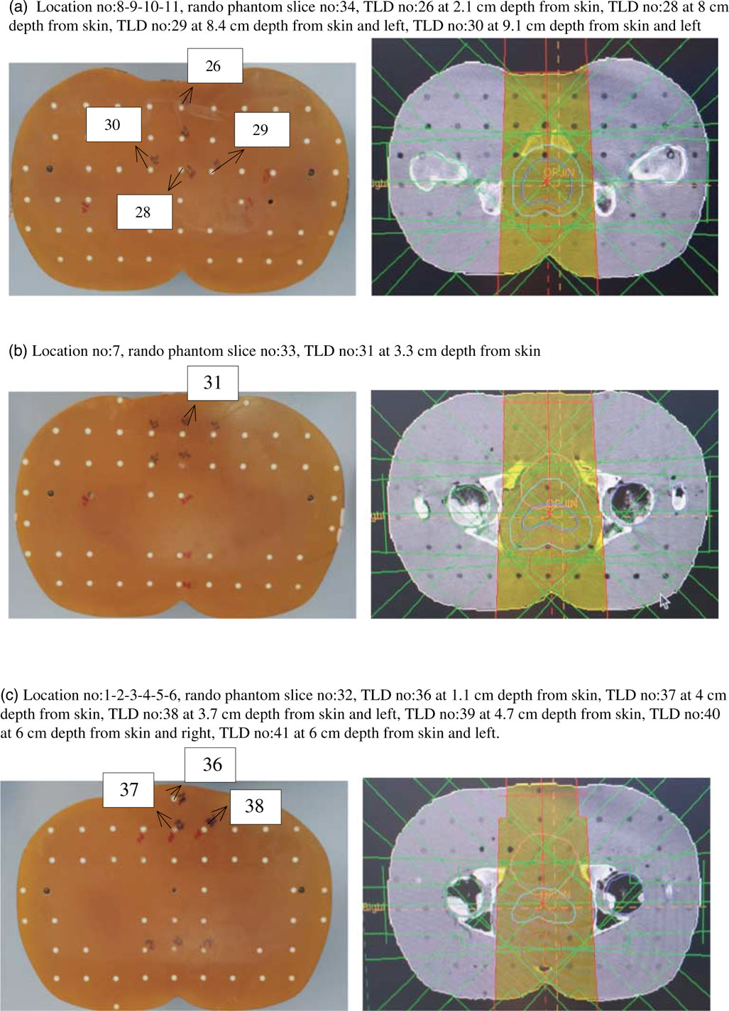 Dosimetric comparison of treatment planning systems using collapsed ...