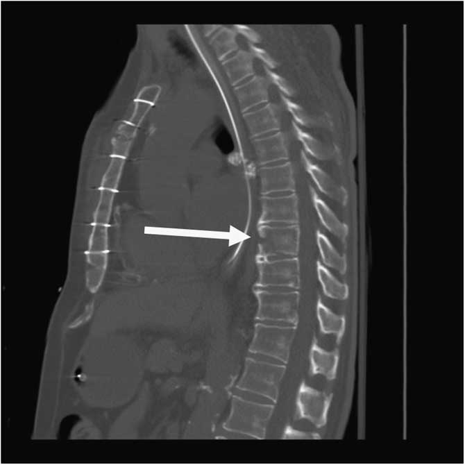 Thoracic Spine Fracture in a Survivor of Out-of-Hospital Cardiac Arrest ...