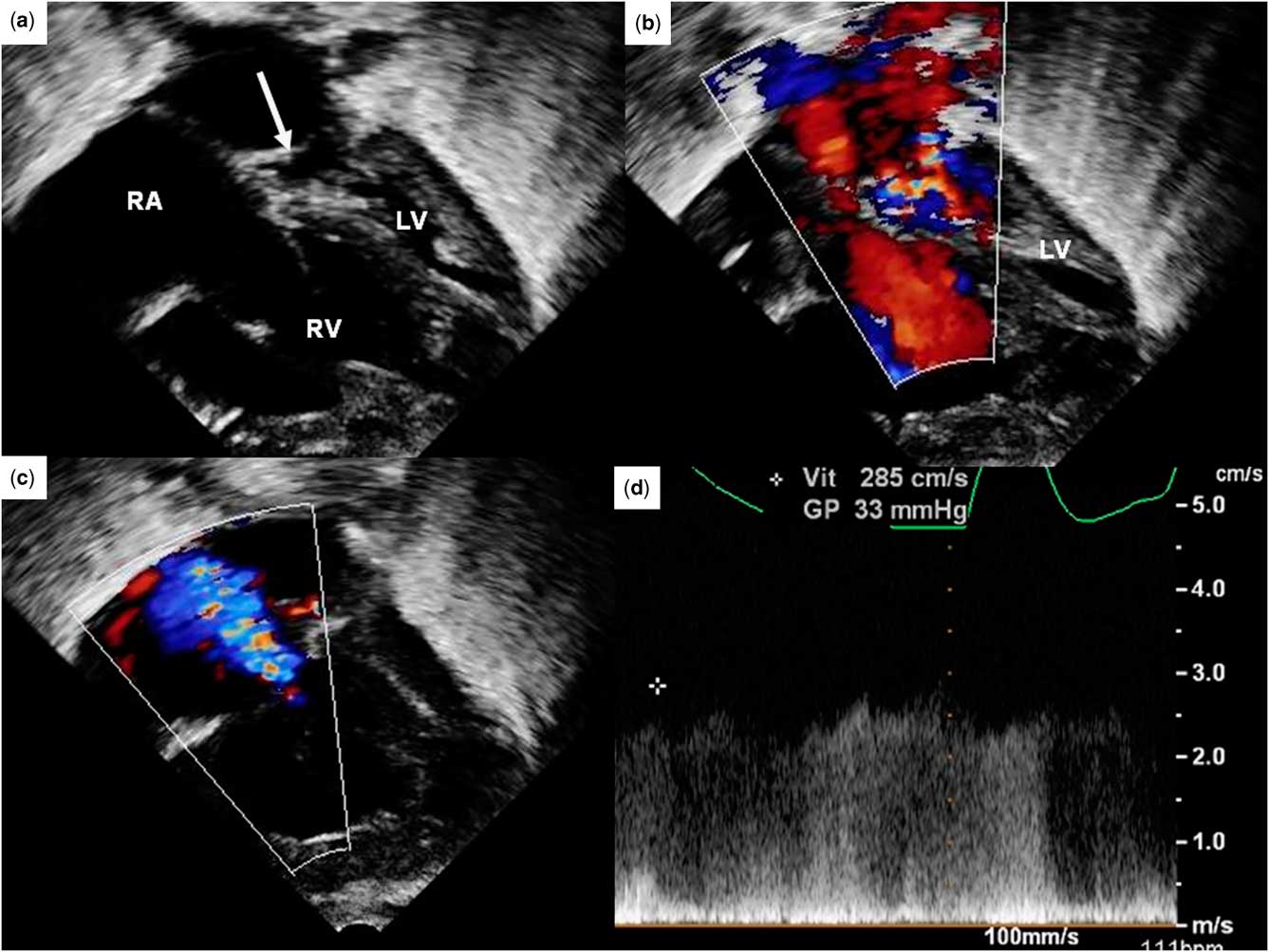 Three-dimensional transthoracic echocardiographic assessment of ...