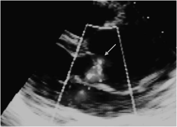 A case of neonatal Marfan syndrome with good late follow-up: is it ...