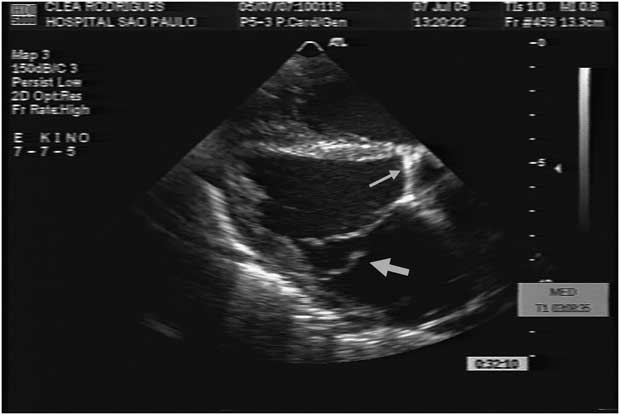 A case of neonatal Marfan syndrome with good late follow-up: is it ...