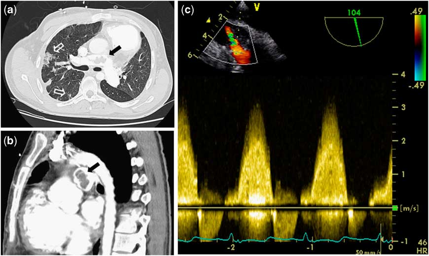 Central pulmonary thrombosis secondary to severe infection of a right ventricle-to-pulmonary ...