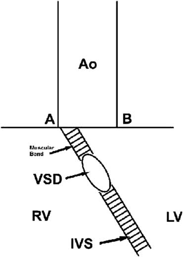 Tips and pearls for “true” dextroposition of the aorta in tetralogy of ...