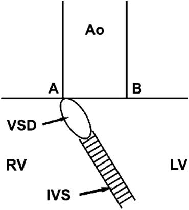 Tips and pearls for “true” dextroposition of the aorta in tetralogy of ...