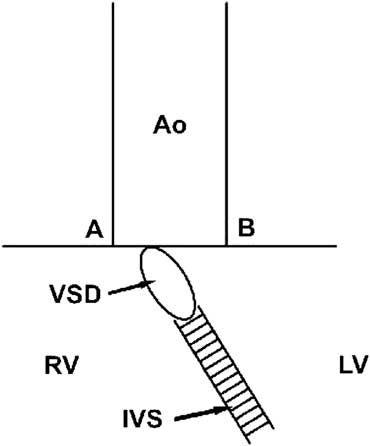 Tips and pearls for “true” dextroposition of the aorta in tetralogy of ...