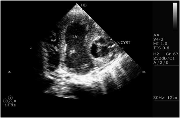 Left ventricular hydatid cyst: an uncommon cause of chest pain in young ...
