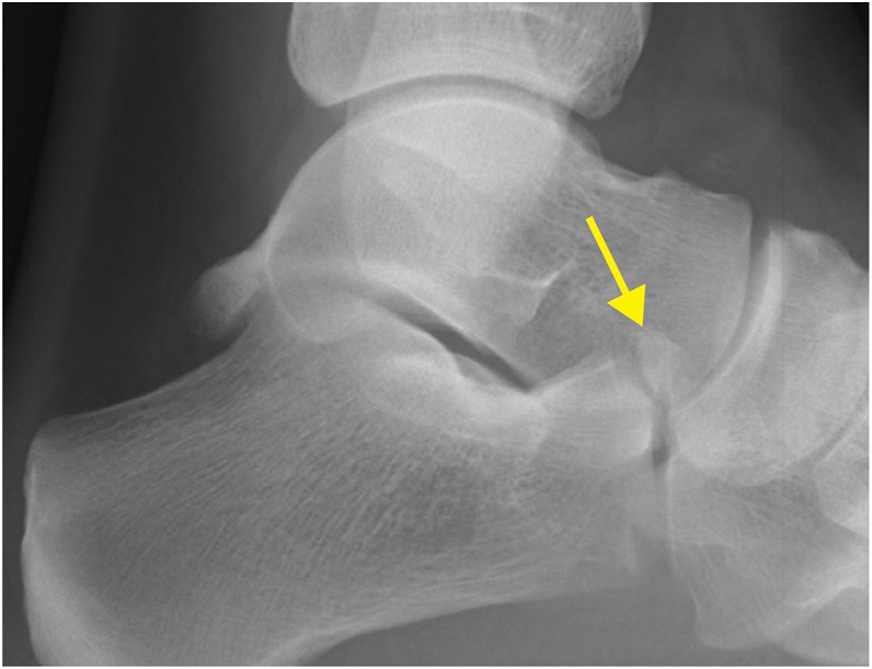 Talus Avulsion Fracture