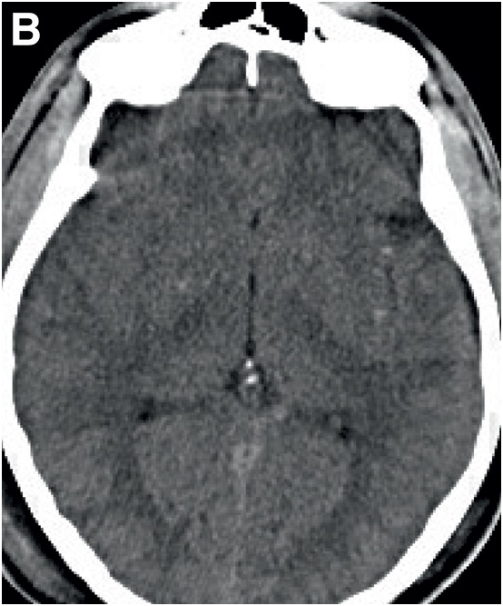 Diffuse Axonal Injury Ct Scan