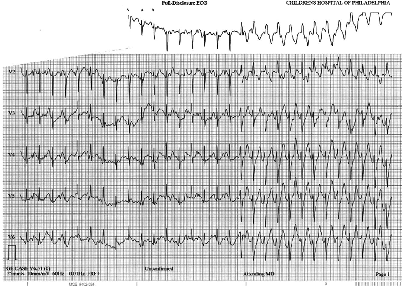 Sudden cardiac death in the young: the value of exercise testing ...