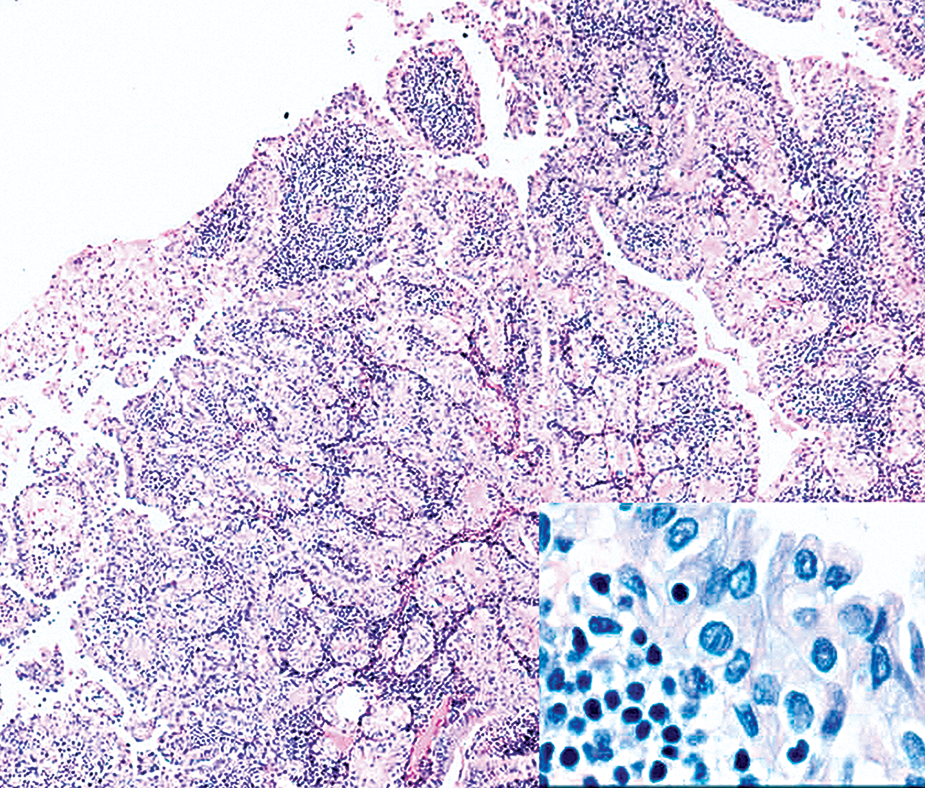 Pretibial Myxedema Pathology