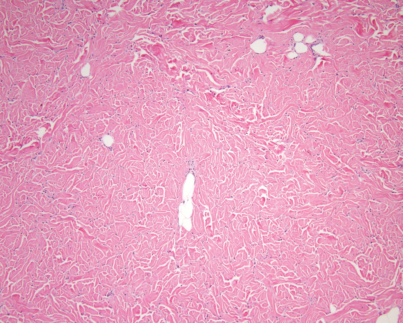 Thrombosed Hemorrhoid Histology