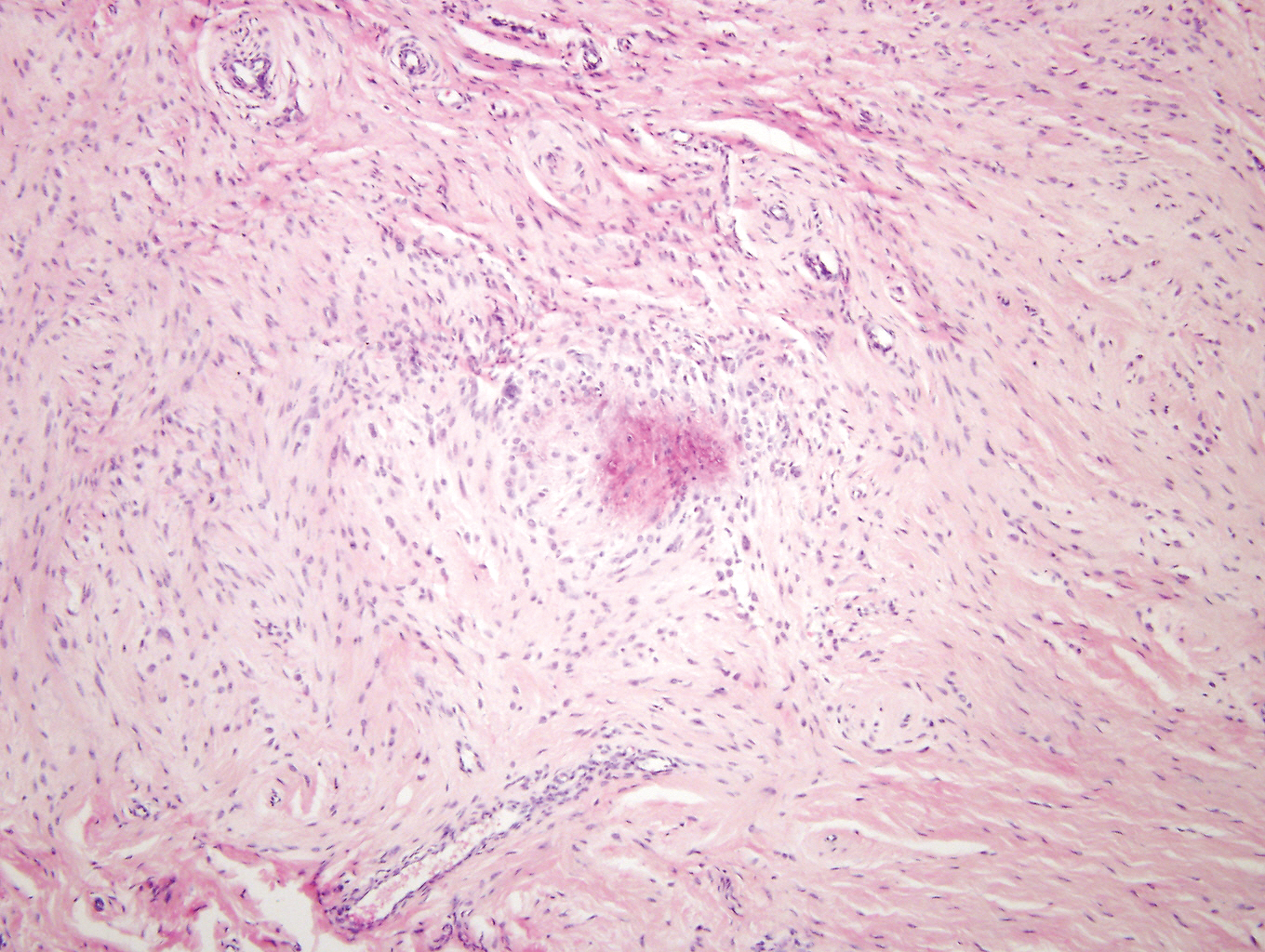 Thrombosed Hemorrhoid Histology