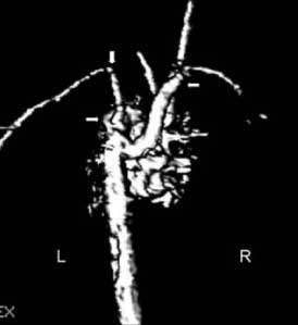 The management of hypoplastic left heart syndrome with a right aortic ...