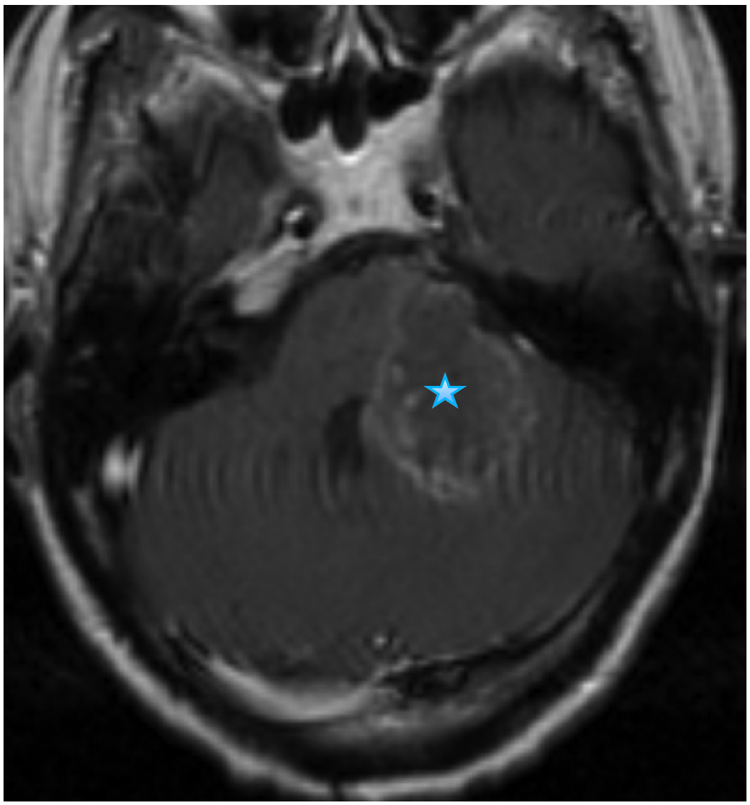 Cerebellopontine Angle Lipoma Mri