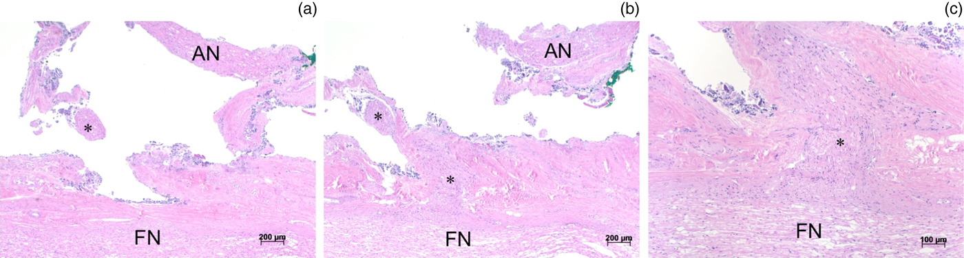 Effects of a sensory branch to the posterior external ear canal ...