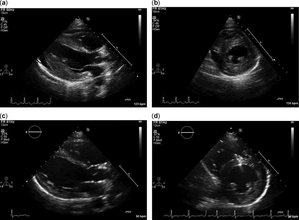 Transient left ventricular wall thickening in a 14-year-old girl with ...