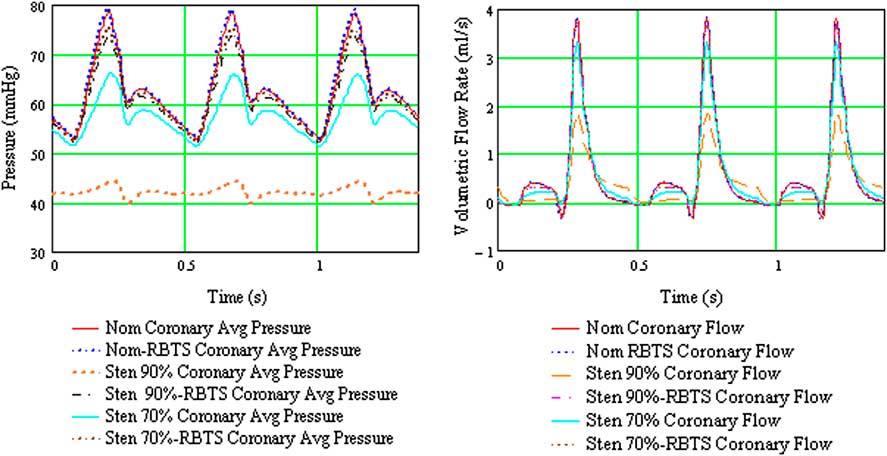 Computational fluid dynamics in congenital heart disease* | Cardiology ...