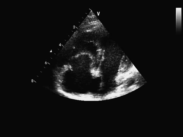 Cor triatriatum dexter masquerading as Ebstein's anomaly | Cardiology ...