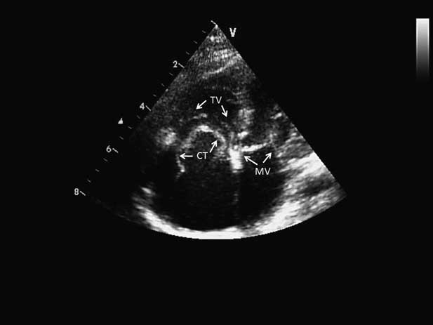 Cor triatriatum dexter masquerading as Ebstein's anomaly | Cardiology ...