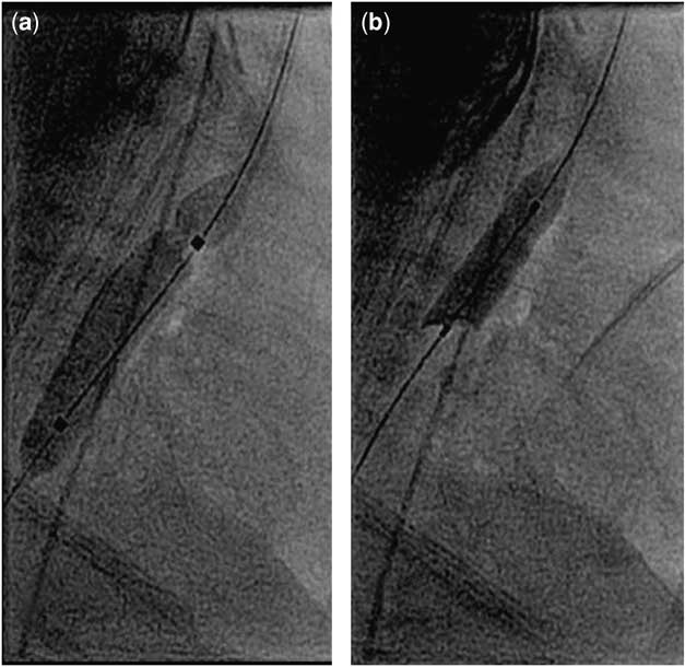 Interventional treatment of critical coarctation of the aorta in an ...