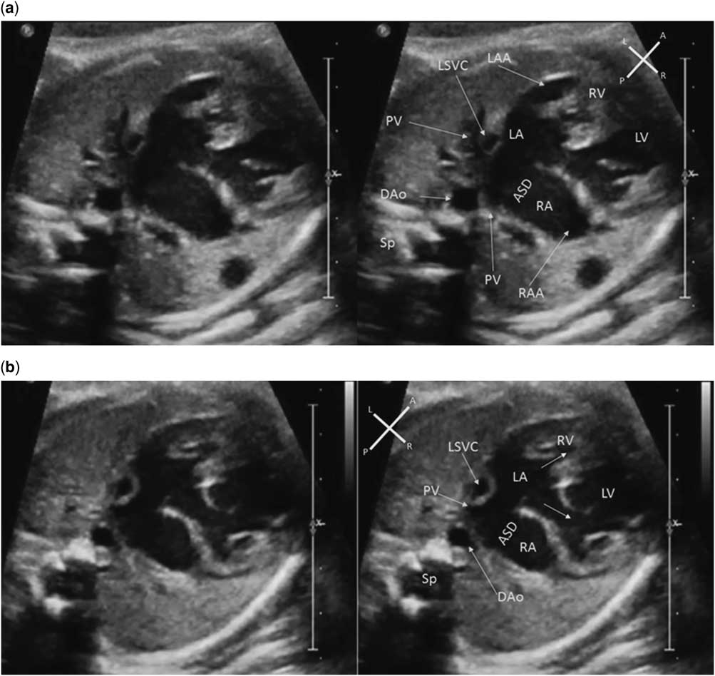 Antenatal diagnosis of double-outlet left atrium | Cardiology in the ...