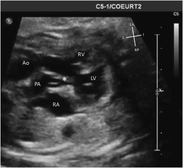 Antenatal diagnosis of double-outlet left atrium | Cardiology in the ...