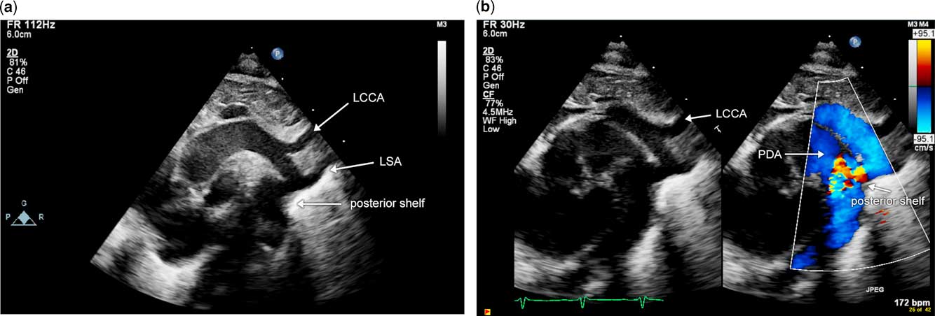 Echocardiography of coarctation of the aorta, aortic arch hypoplasia ...
