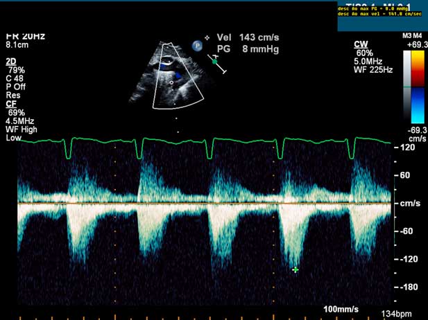 Echocardiography of coarctation of the aorta, aortic arch hypoplasia ...