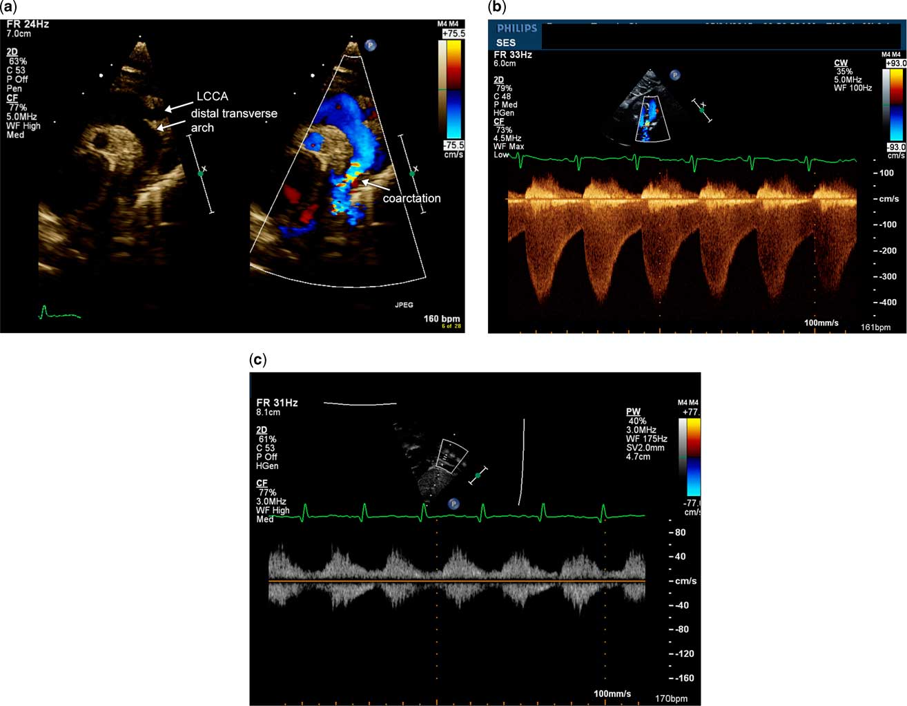 Echocardiography of coarctation of the aorta, aortic arch hypoplasia ...
