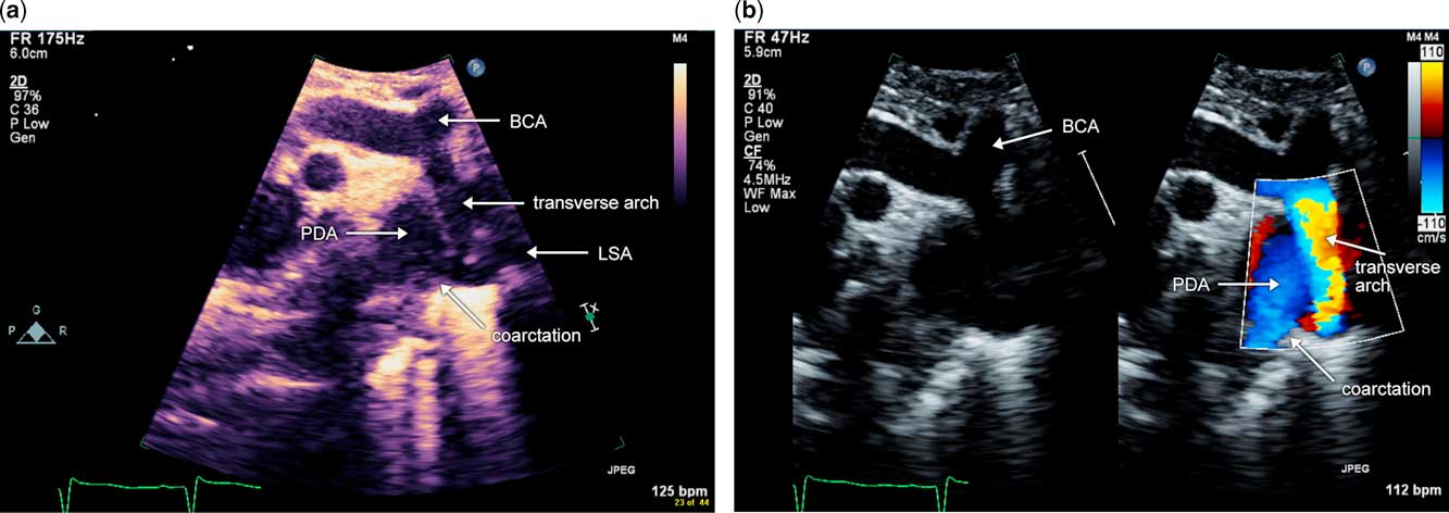 Echocardiography of coarctation of the aorta, aortic arch hypoplasia ...