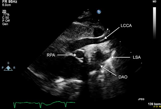 Echocardiography of coarctation of the aorta, aortic arch hypoplasia ...