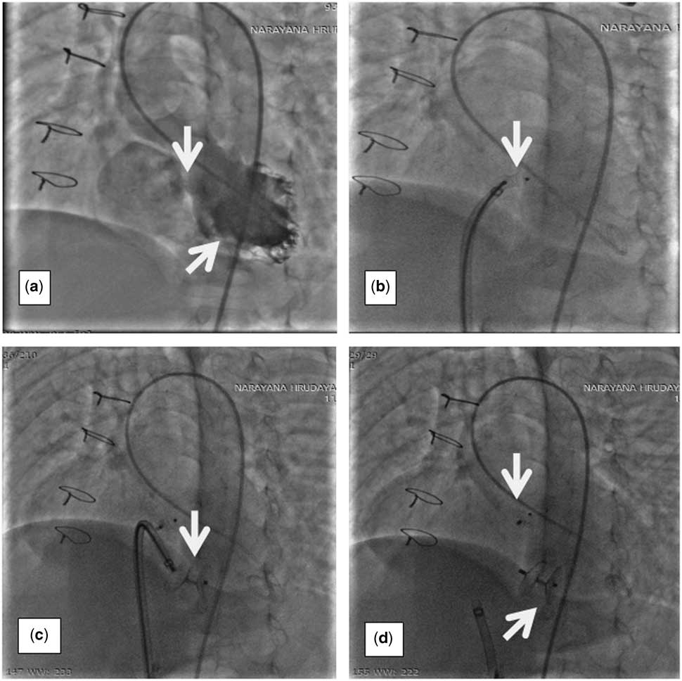 Percutaneous closure of multiple ventricular septal defects ...