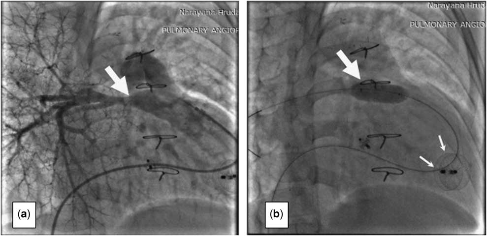 Percutaneous closure of multiple ventricular septal defects ...