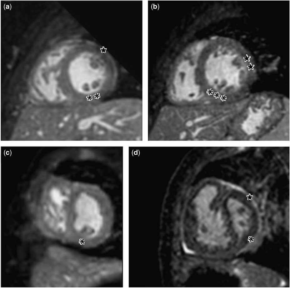 Morphological three-dimensional analysis of papillary muscles in ...