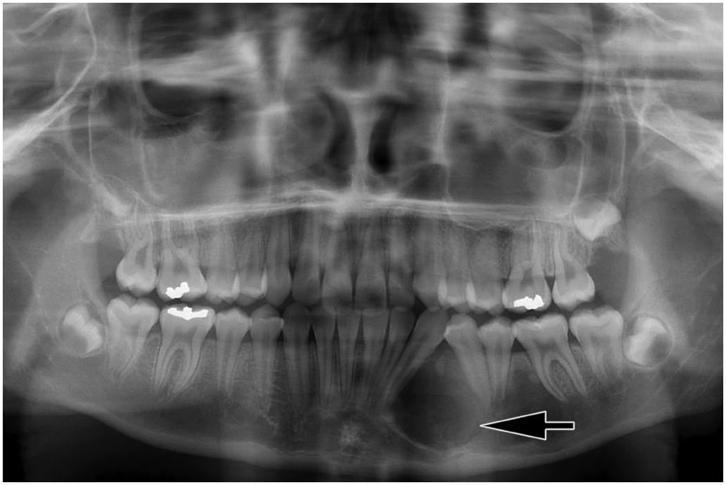 Peripheral Ossifying Fibroma Radiograph