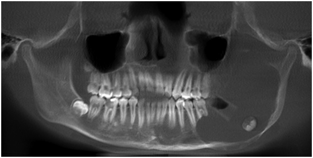 Botryoid Odontogenic Cyst