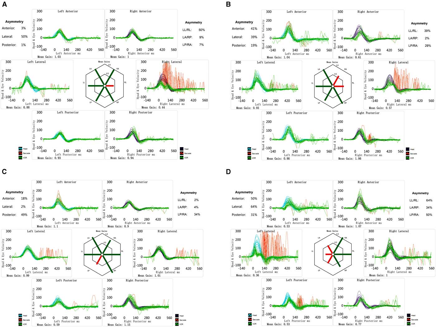 Video Head Impulse Test for Early Diagnosis of Vestibular Neuritis ...