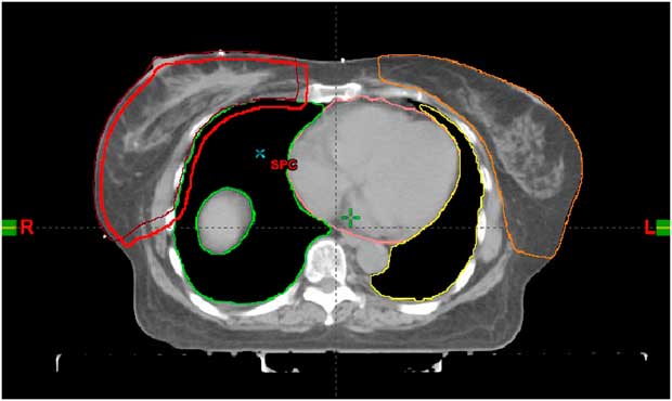 Dosimetric study of three-dimensional conformal radiotherapy ...