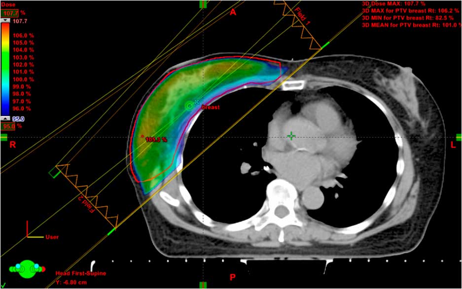 Dosimetric study of three-dimensional conformal radiotherapy ...