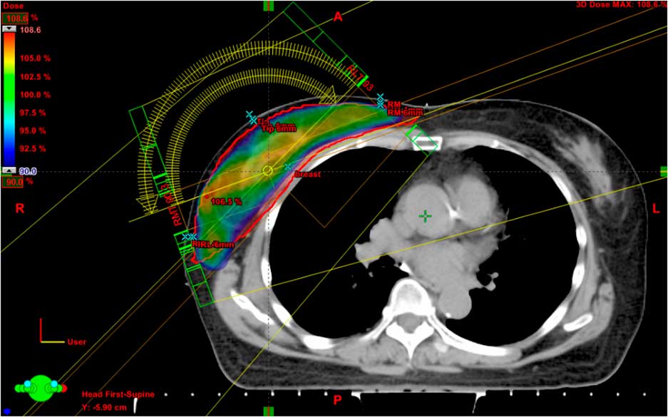 Dosimetric study of three-dimensional conformal radiotherapy ...