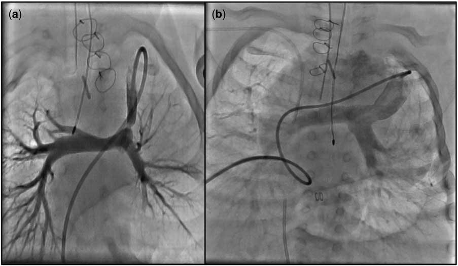 Femoral vein homograft as Sano shunt results in improved pulmonary ...