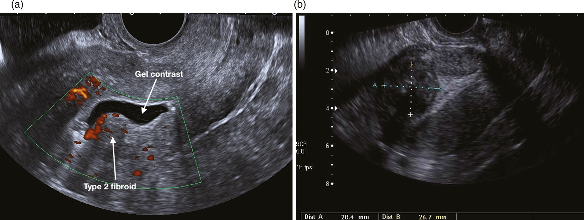 Abnormal Uterine Bleeding On Ultrasound Abnormal Uterine Bleeding