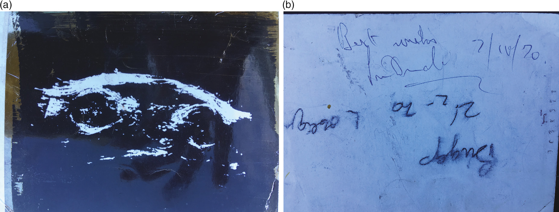 A Short History of Ultrasound in Gynaecology (Chapter 1) - Ultrasound ...