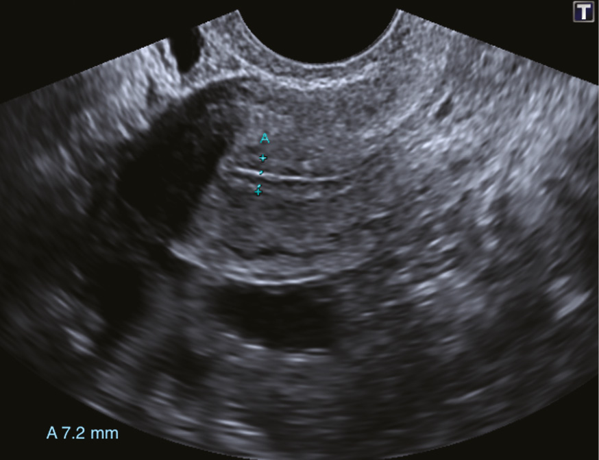 Normal Pelvic Ultrasound Transvaginal Image