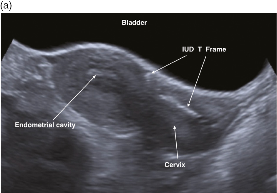 Paragard Iud Ultrasound Ultrasound Imaging In Relation To Intrauterine