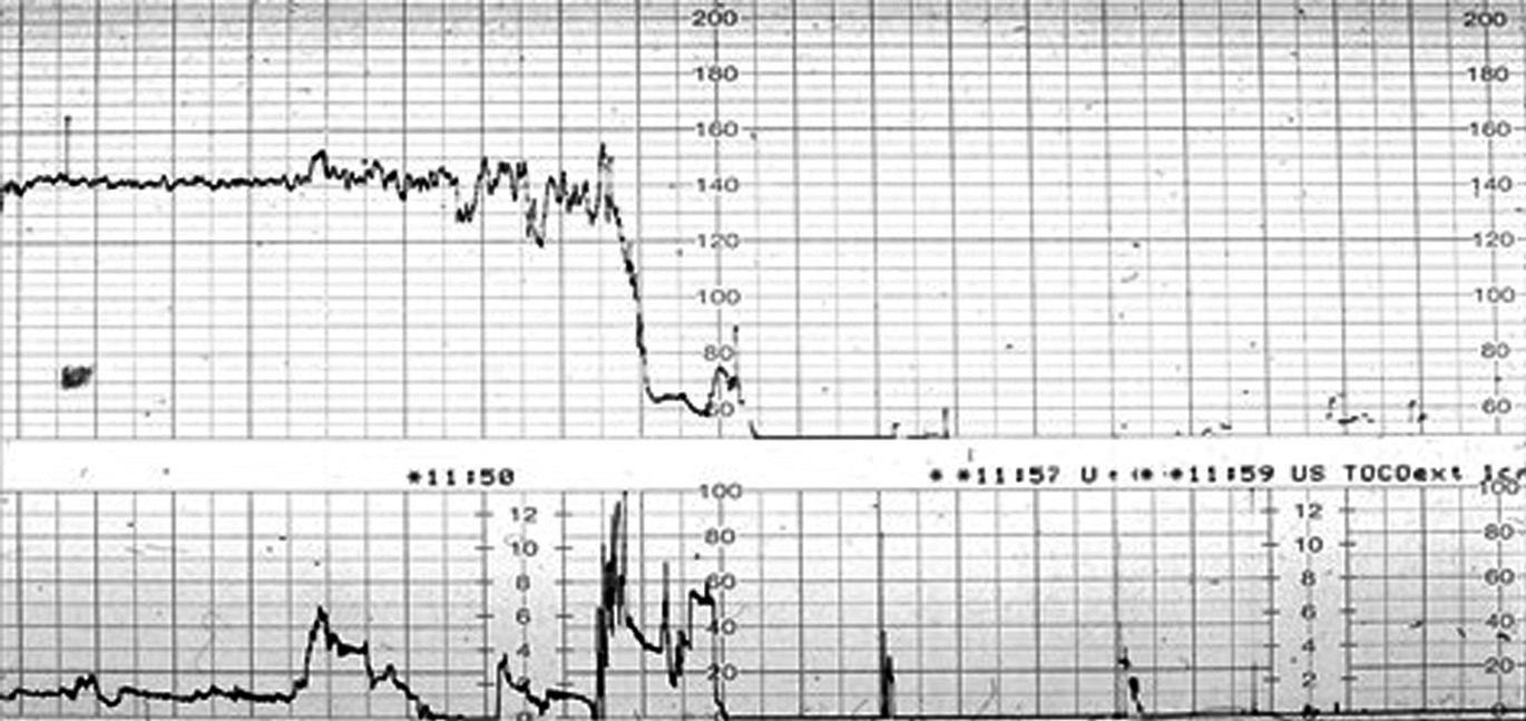 Nonhypoxic Causes Of CTG Changes (Chapter 27) Handbook Of, 48% OFF