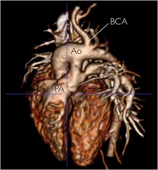 Persistent fifth aortic arch: the “great pretender” in clinical ...